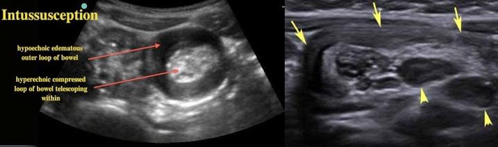 intussusception grading