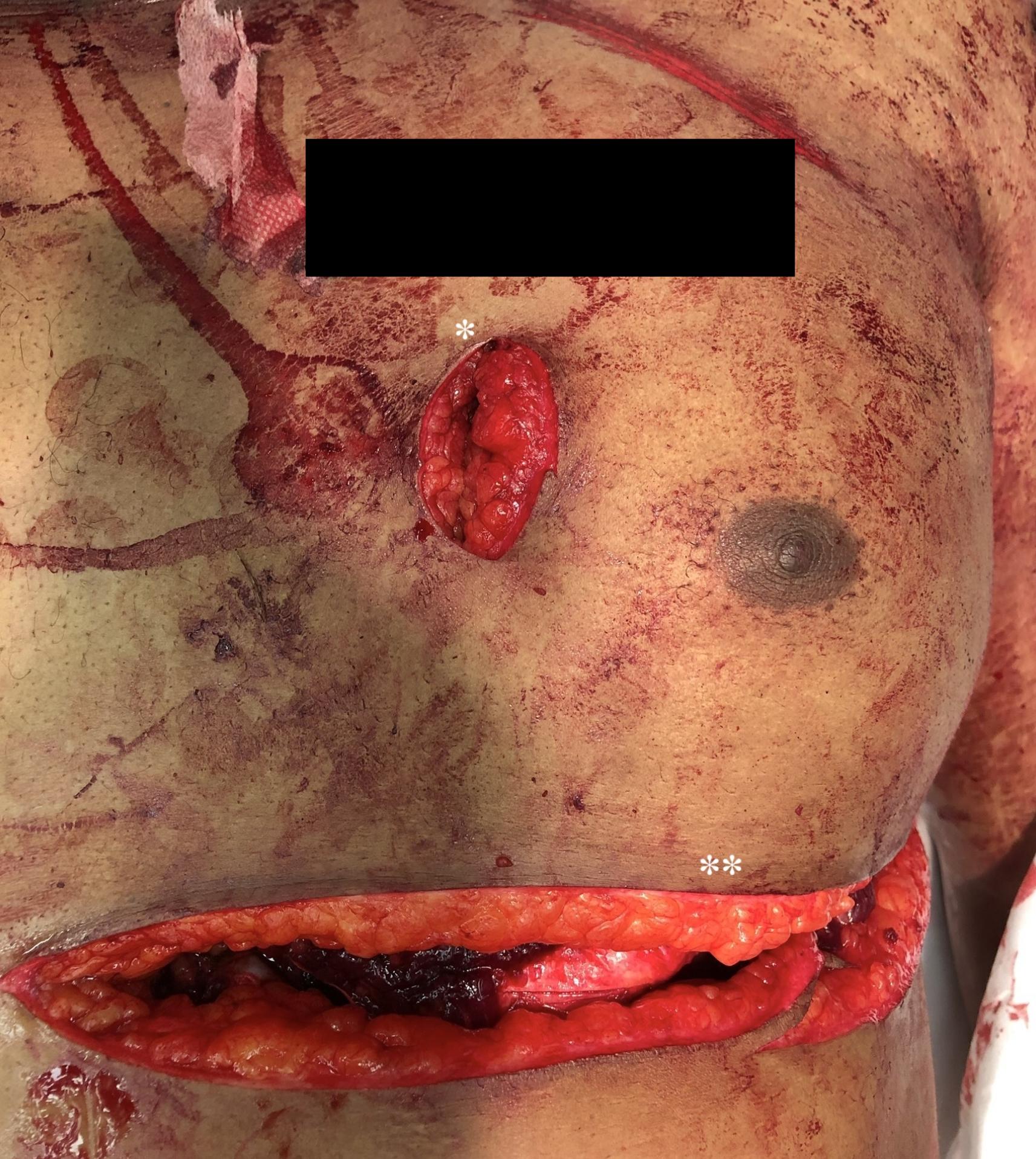 posterolateral thoracotomy cpt code