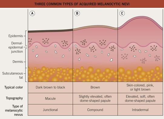 benign compound nevus