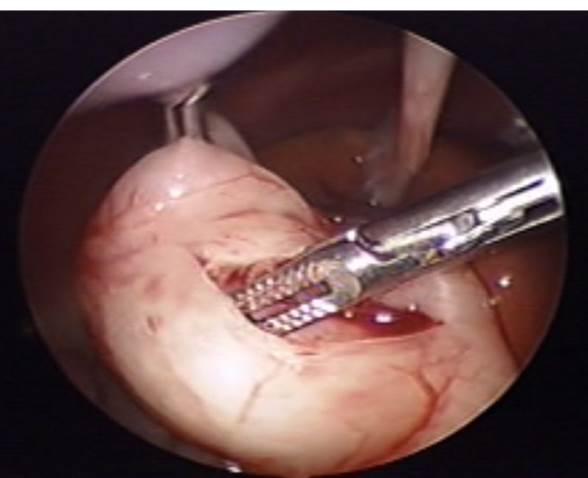 pyloromyotomy position