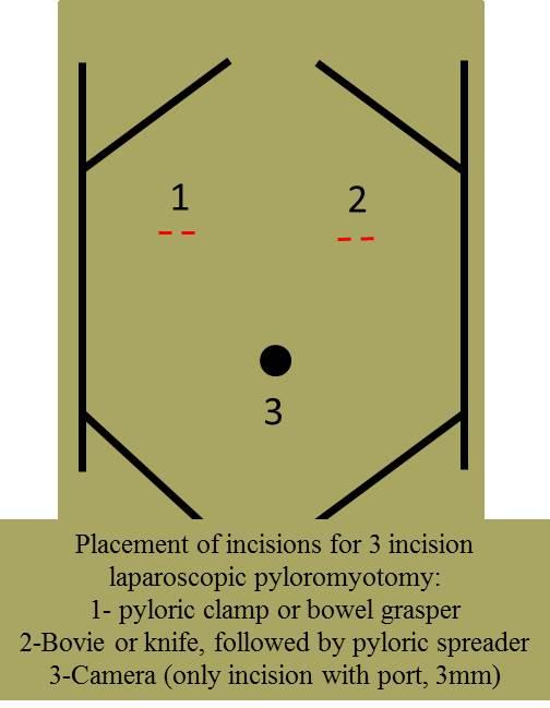 pyloromyotomy position
