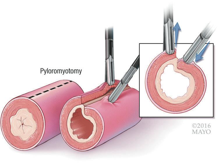 pyloromyotomy position