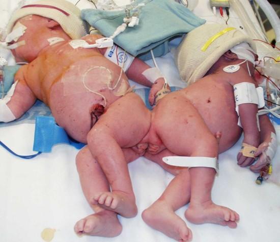 pygopagus separation