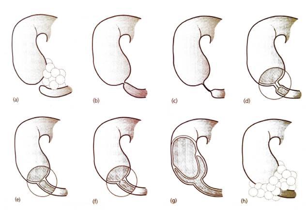 duodenojejunostomy steps
