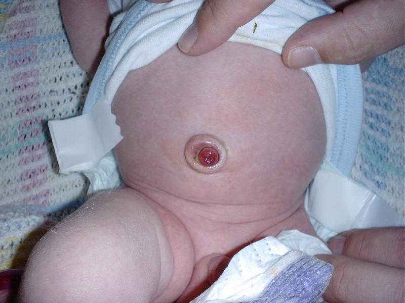 omphalomesenteric cyst