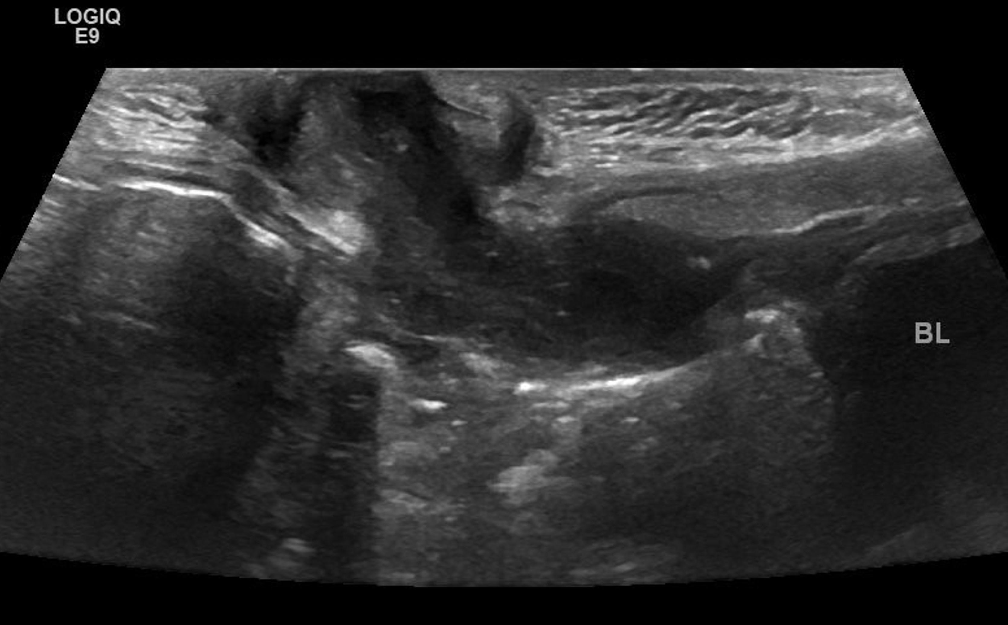 urachus persistens ultrasound