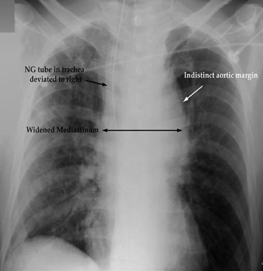 traumatic aortic rupture