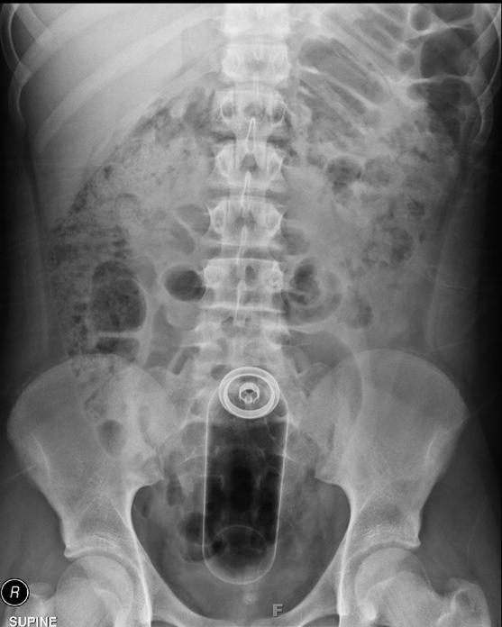 rectal foreign body cpt code