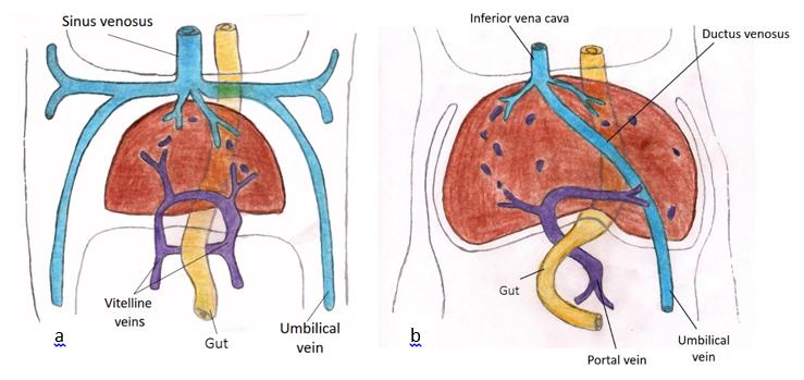 mesocaval shunt embolization
