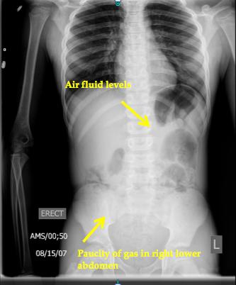 intussusception x ray features