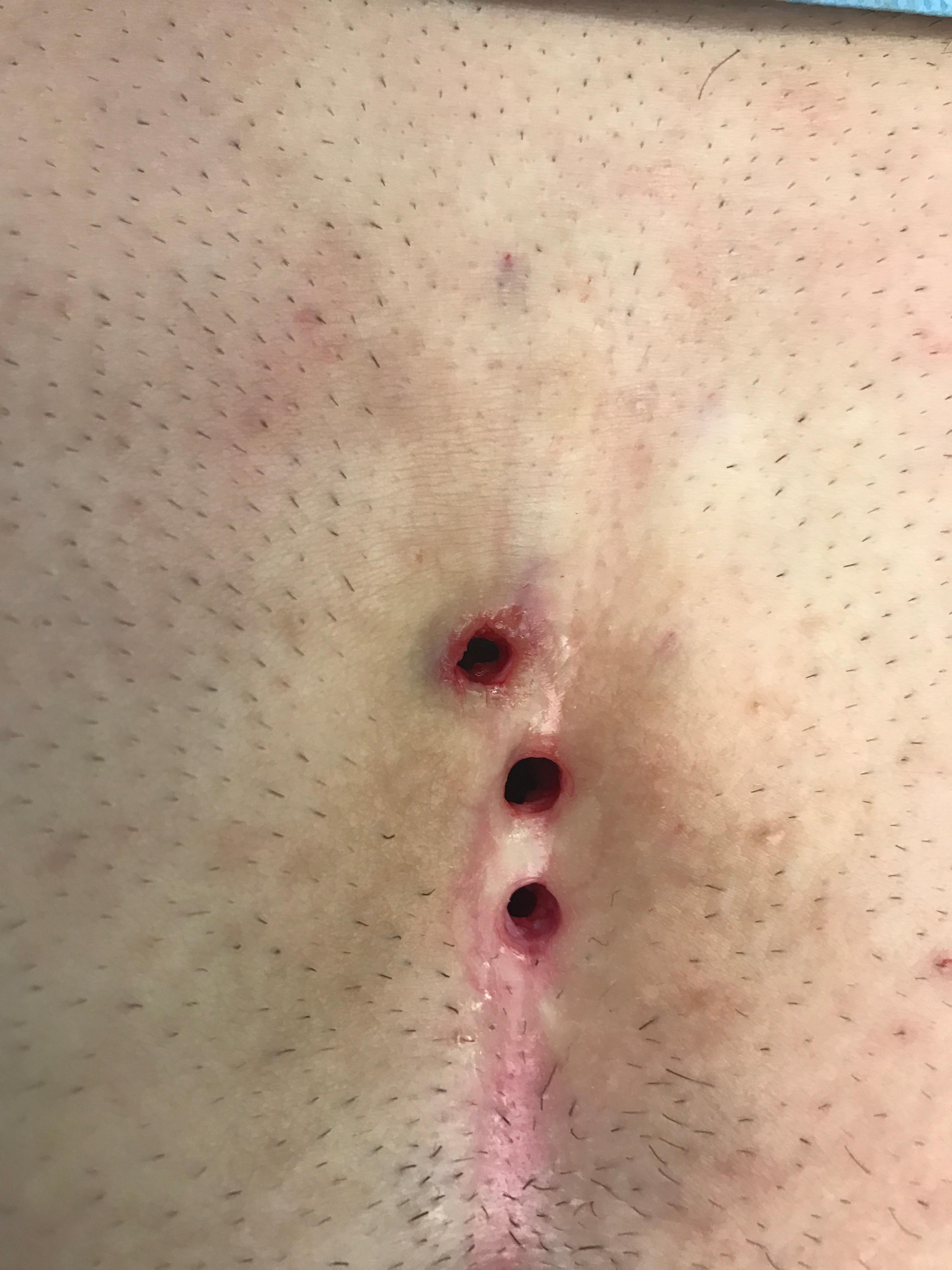 pilonidal sinus child