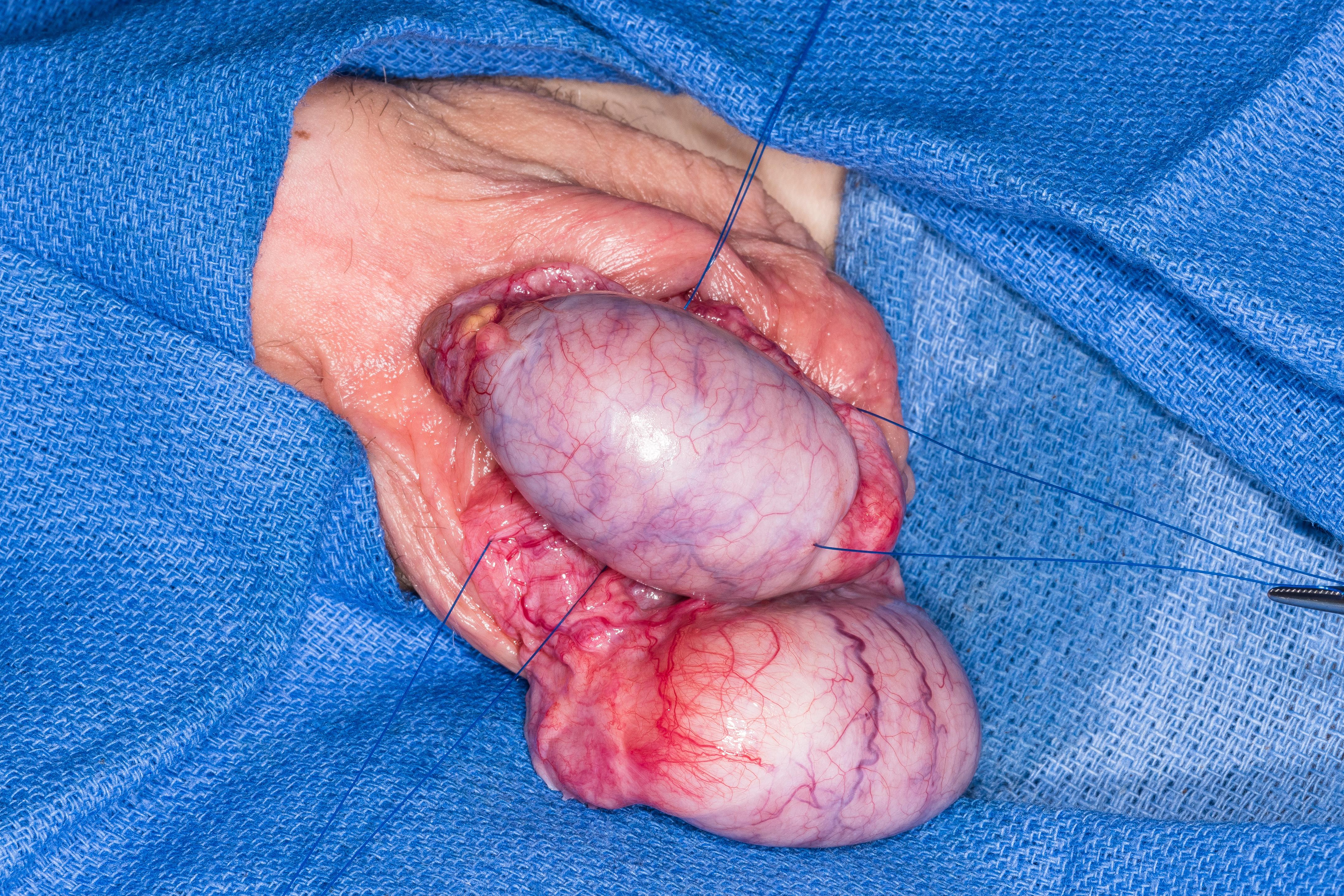 testicle removal surgery