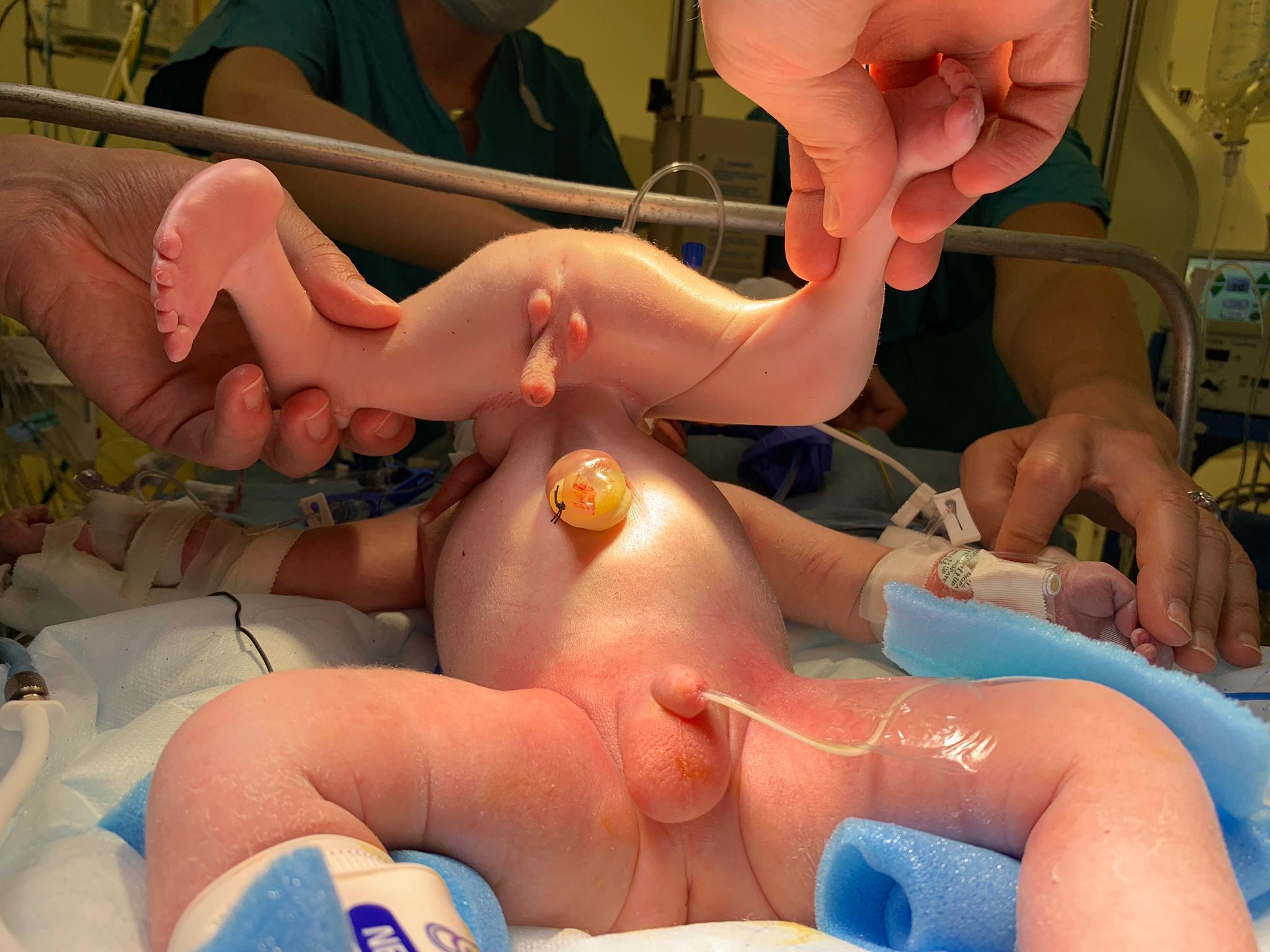 omphalopagus conjoined