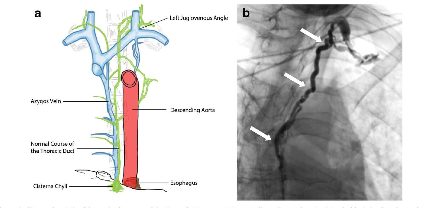 thoracic duct embolization