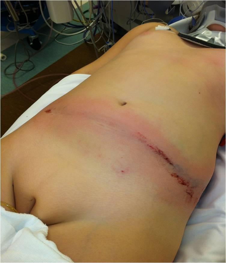 pediatric abdominal trauma