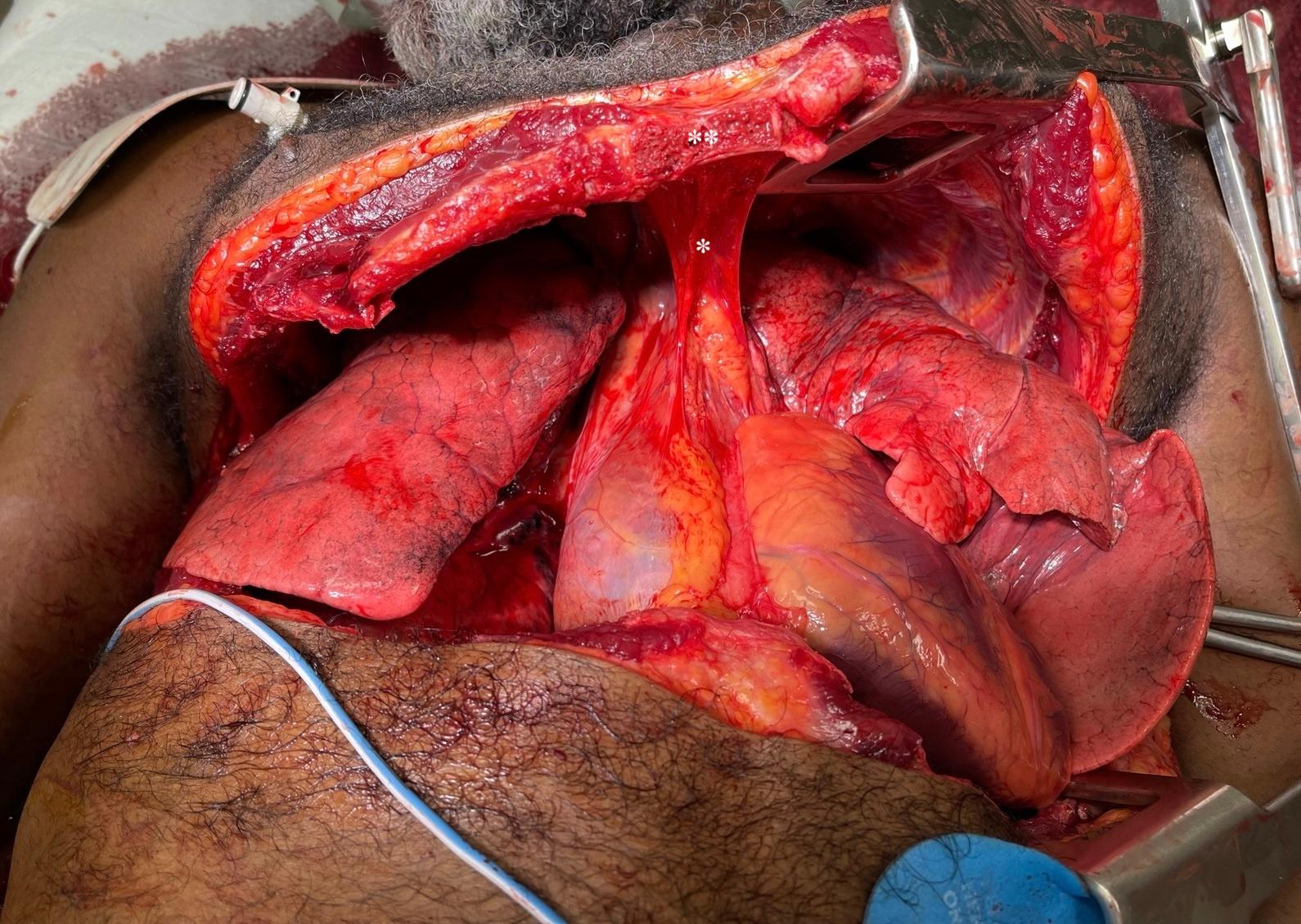 posterolateral thoracotomy cpt code