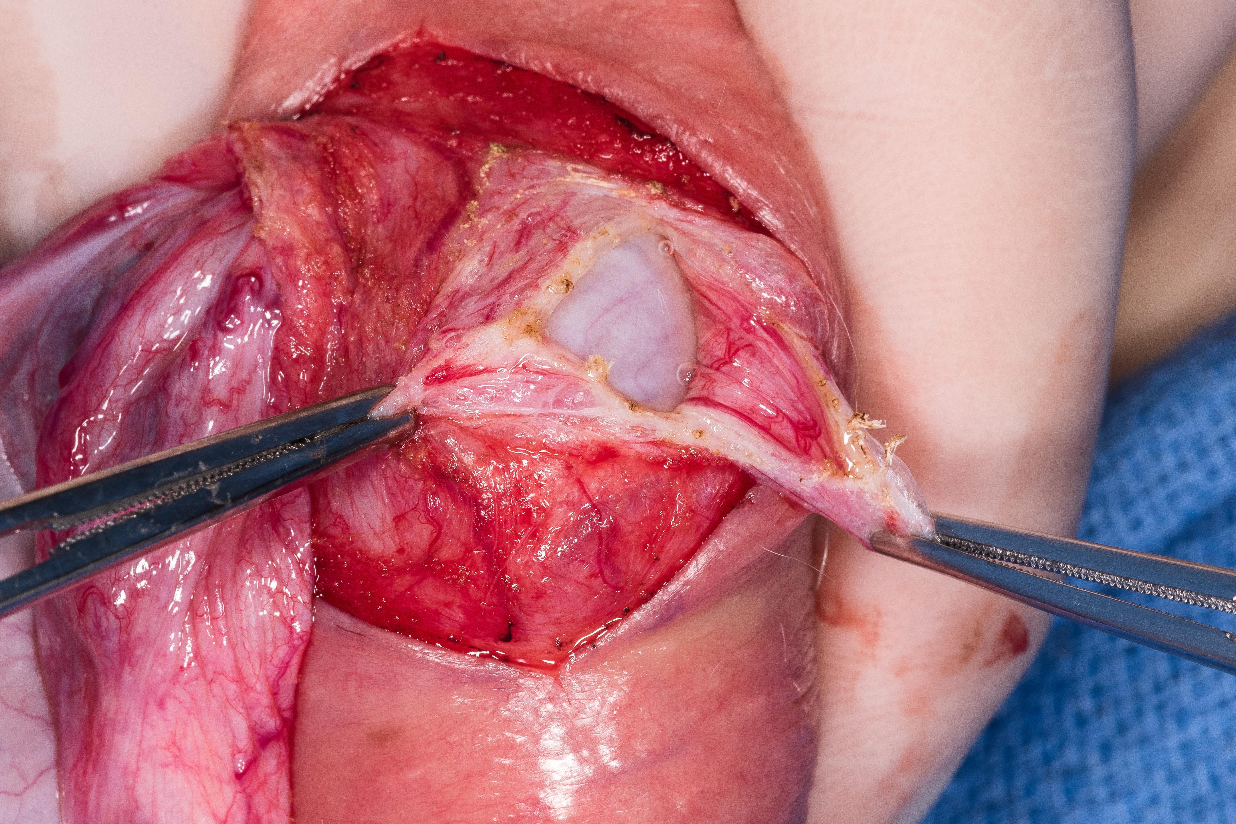 orchiopexy procedure steps