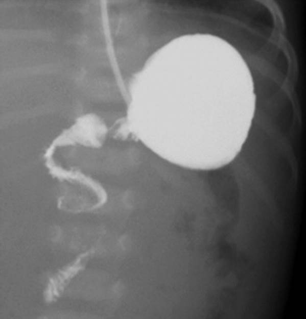 malrotation paediatrics