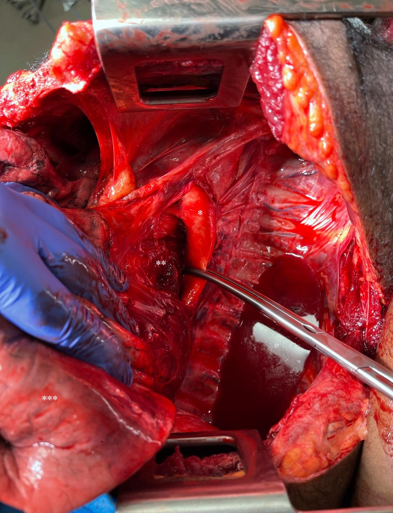 clamshell heart surgery
