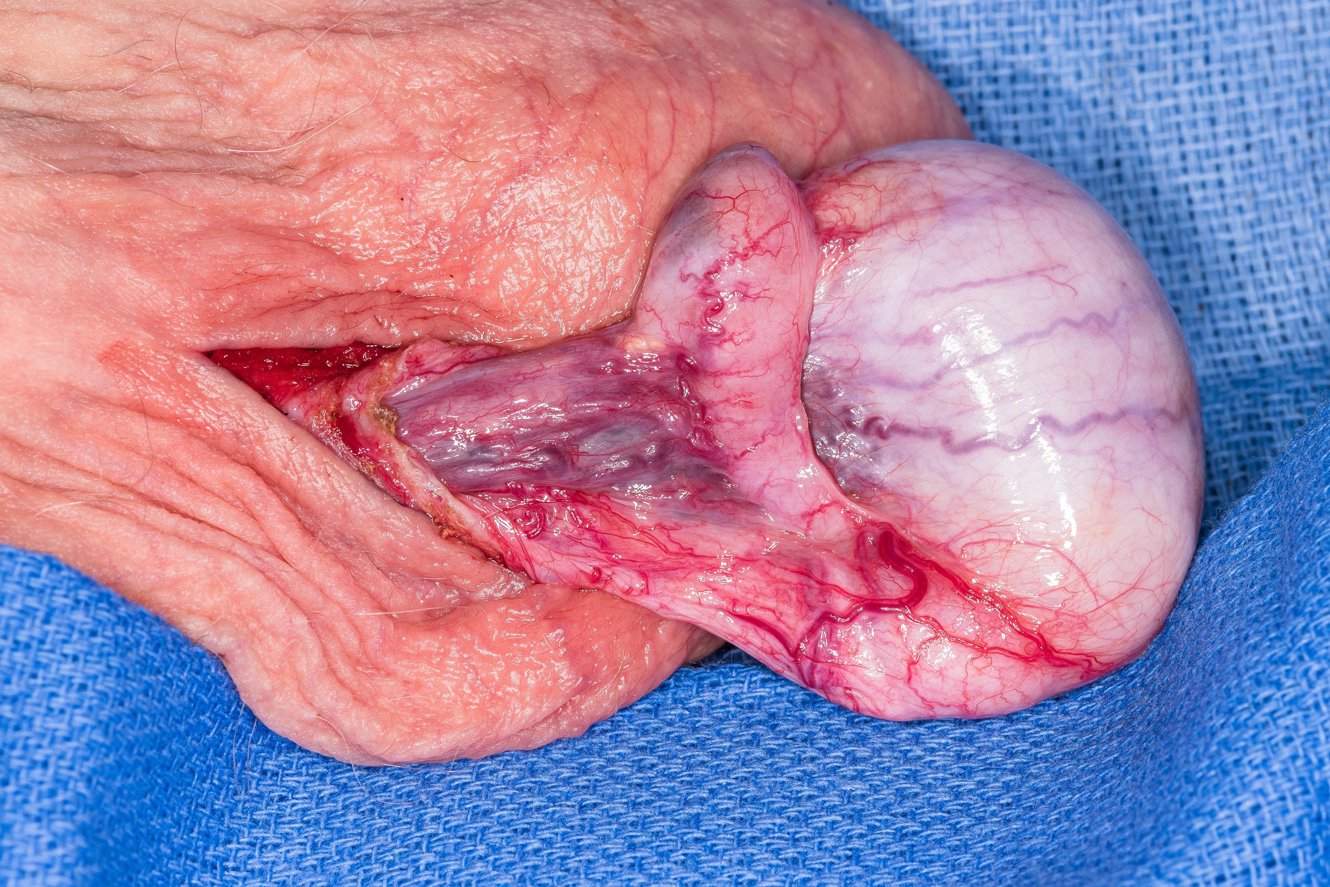 testicle removal surgery