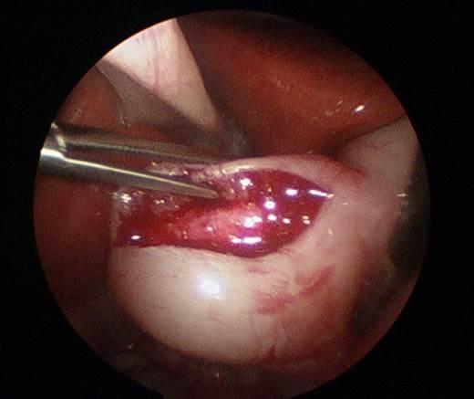 pyloromyotomy position
