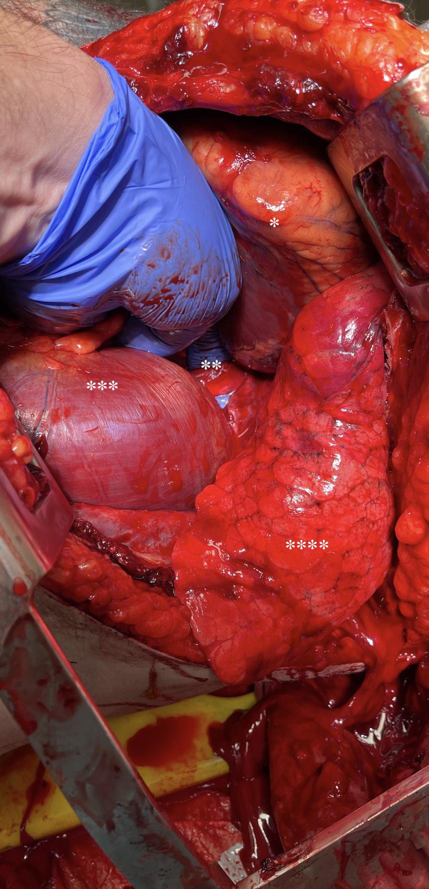 posterolateral thoracotomy cpt code